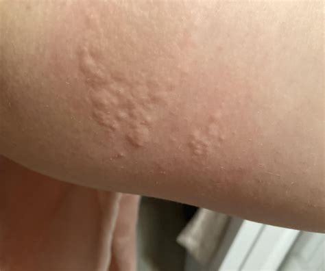 Raised Localized Rash 33f R Askdocs