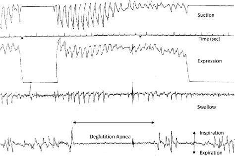Simultaneous Monitoring Of The Nutritive Sucking Suction And Download Scientific Diagram