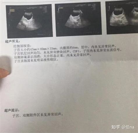 得了巧克力囊肿我自愈了！亲身经历分享！ 知乎