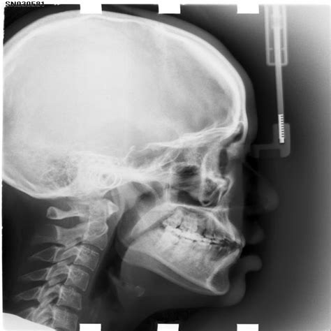 Ceph Object Detection Dataset And Pre Trained Model By Andrea