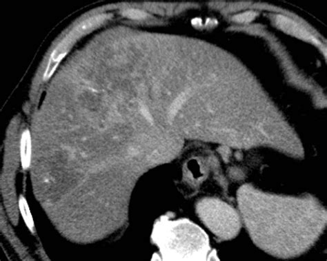 Liver Atlas Diagnosis Echinococcosis Alveolar