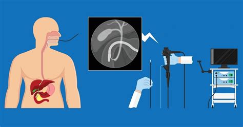 Cholangio Pancréatographie Endoscopique