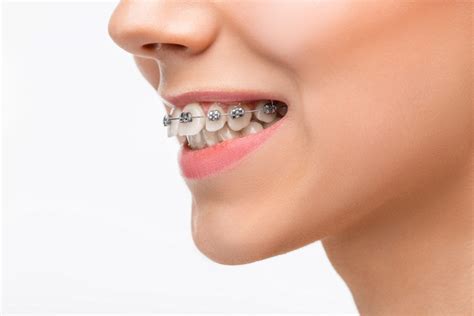 Wisdom Teeth And Braces Phoenix Dunn Orthodontics