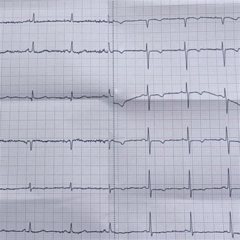 Electrocardiogram ECG Revealed ST Depression And T Waves Inversion In Download Scientific