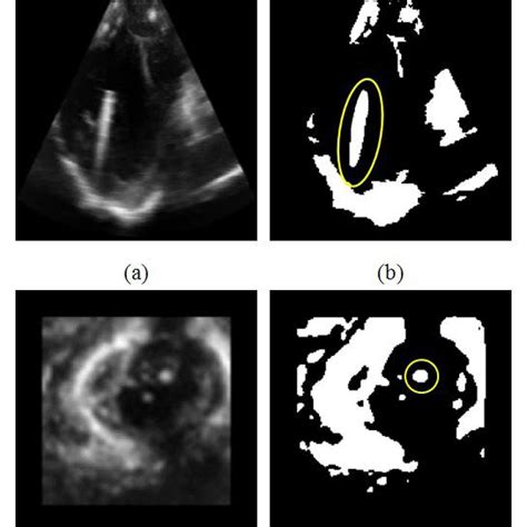 slice of long axis view a and its automatic thresholding b slice