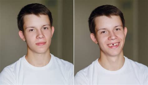 Shame Over Missing Front Tooth And How To Fix It SA West