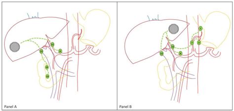 The Role Of Lymphadenectomy In The Surgical Treatment Of Intrahepatic
