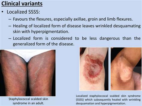 Staphylococcal Scalded Skin Syndrome Made Very Easy Pptx