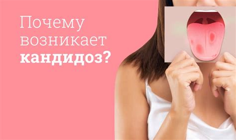 Кандидоз симптомы и лечение у женщин и мужчин Клинические рекомендации