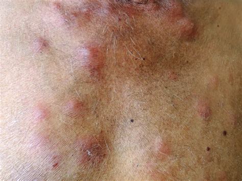 Erythema Nodosum Face Erythema Nodosum Stock Image C044 3058