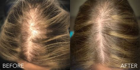 Zinc Deficiency Hair Loss