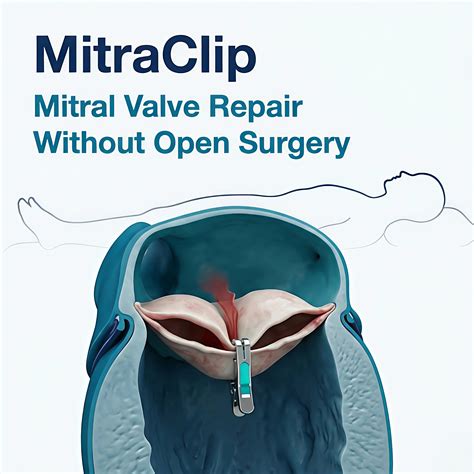 Mitral Valve Repair Mitraclip Apollo Cvhf