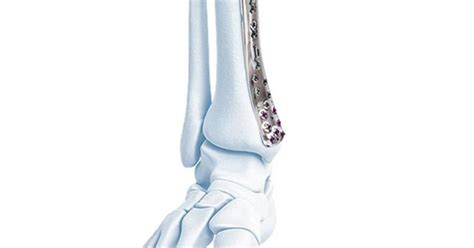 Synthes VA Ankle Trauma How Does It Help