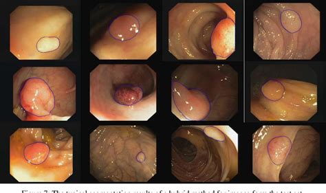 Figure 7 From Giana Polyp Segmentation With Fully Convolutional Dilation Neural Networks