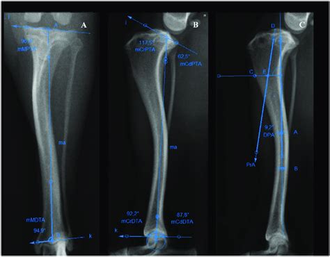 Measurements Of Tibial Alignment In The Frontal And Sagittal Planes Download Scientific