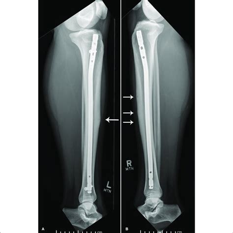 Radiographic Positioning Tibia Fibula