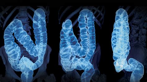 Diagnosis And Management Of Acute Diverticulitis
