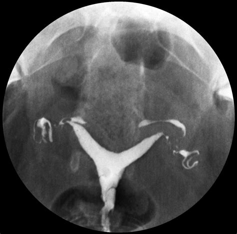 Management Of Congenital Uterine Abnormalities Reproductive