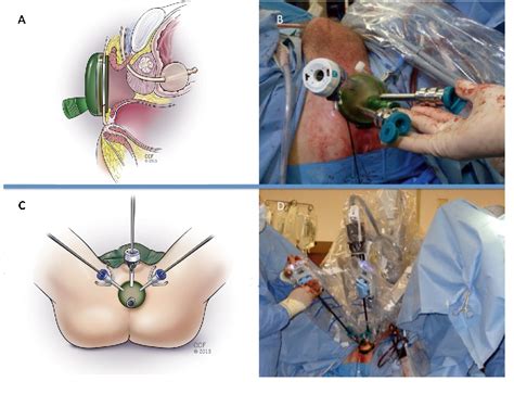 Suprapubic Prostatectomy Procedure