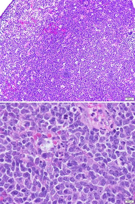 Hematopathology Case Study An 80 Year Old Man With Rapid Onset