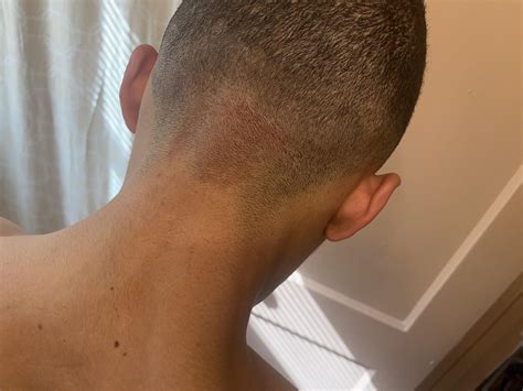 Rash That Appeared After Haircut R Folliculitis
