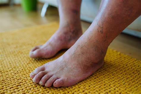 Manage Early Stage Diabetic Foot Ulcers With Podiatric Care