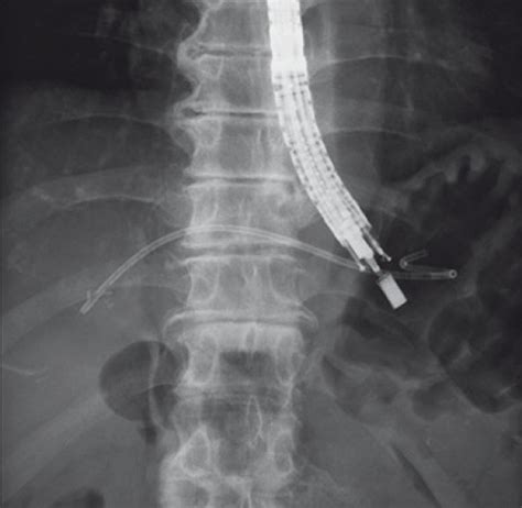A 7f 14 Cm Plastic Stent Was Placed Download Scientific Diagram