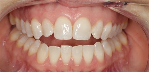 How To Treat An Open Bite Blog Orofacial Myologist In Vaughan