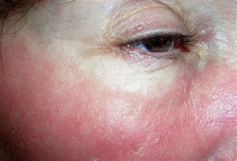 Phototoxic Drug Reaction Picture Image On