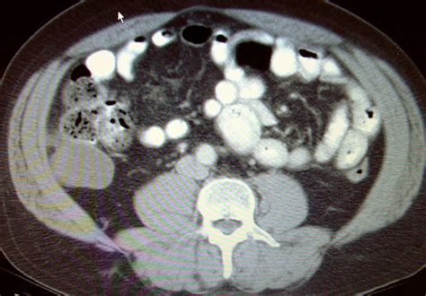 Appendix Neoplasm 1388 Appendix Malignant Mucocele 7 Surgery Photos