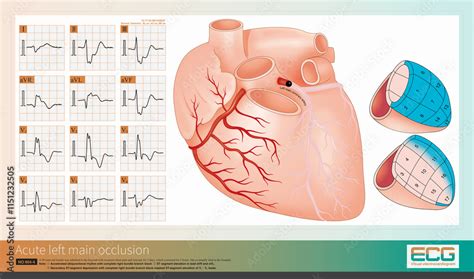 When Acute Left Main Artery Occlusion Causes St Segment Elevation Myocardial Infarction It Is