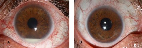 Behcets Disease Presenting With Bilateral Hypopyon Masquerading Imcrj