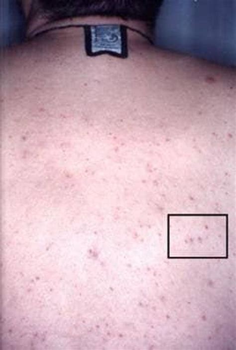 Treatment Of Hypertriglyceridemia Medizzy