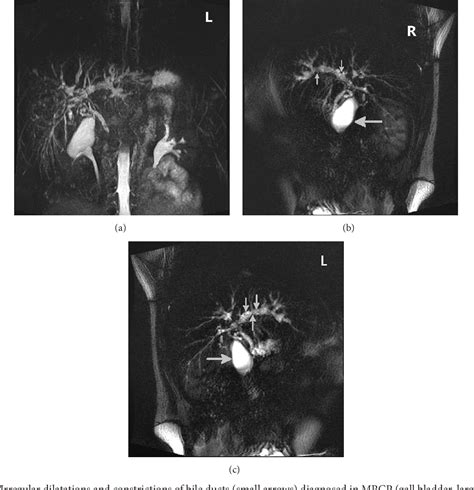 Table 1 From Rapid Progression Of Primary Sclerosing Cholangitis Complicated With Ulcerative