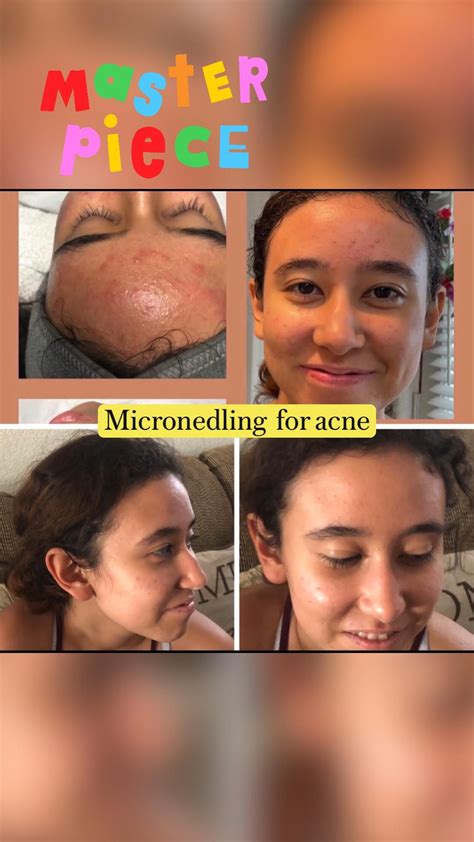 Micronedling For Acne Artofit