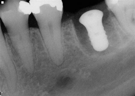 Interradicular Bone Tooth