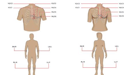 Comment Positionner Les électrodes Ecg Correctement