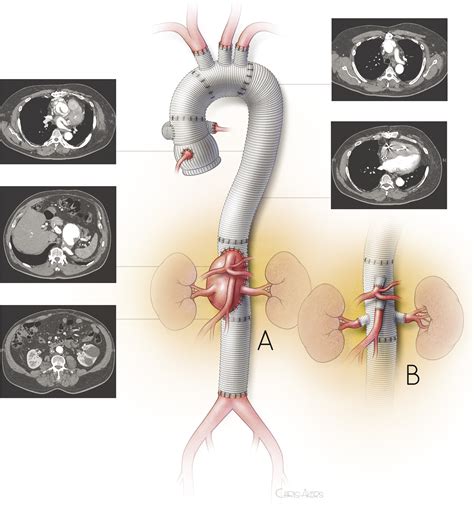 Redo Thoracoabdominal Aortic Aneurysm Repair A Single Center