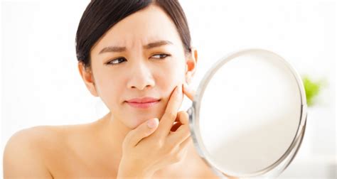 How To Remove Pimple Marks Naturally