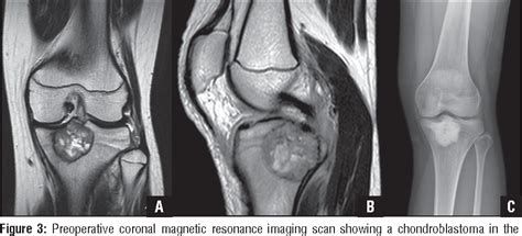 Figure 3 From Proximal Tibia Chondroblastoma Treated With Curettage And Bone Graft And Cement