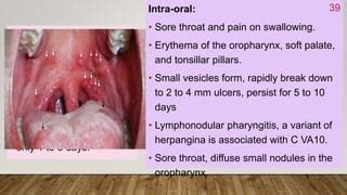 Vesiculo Bullous Lesions Of Oral Cavity Pptx
