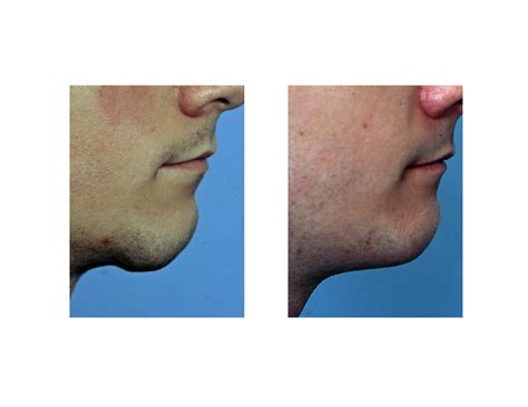 Mentopexy Correction Of The Witchs Chin Deformity Explore Plastic