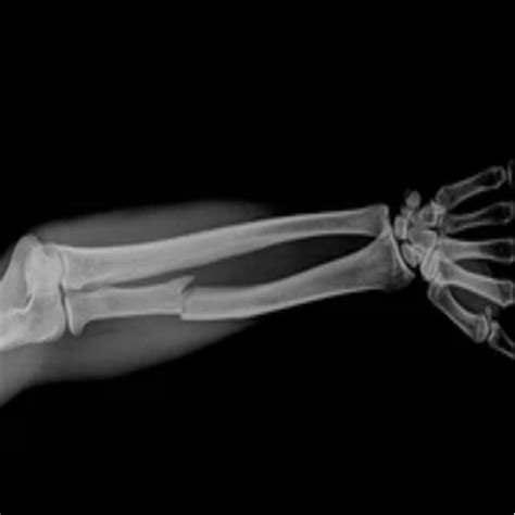 Fracture Object Detection Dataset V1 2023 10 23 11 59am By Symbi