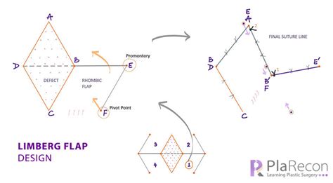 Rhomboid Flap