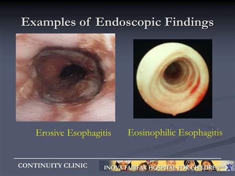 Gerd After Endoscopy At Bruce Green Blog