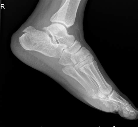Calcaneus Fracture Orthobullets Virsol