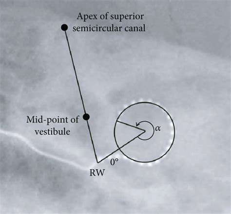 Measurement Of Electrode Insertion Angle The Line Going Through The