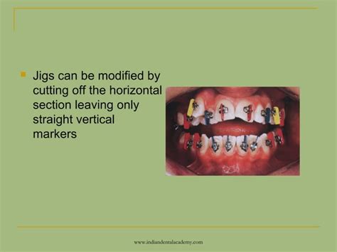 Tip Edge Technique Final PPT Tip Edge Technique Final PPT