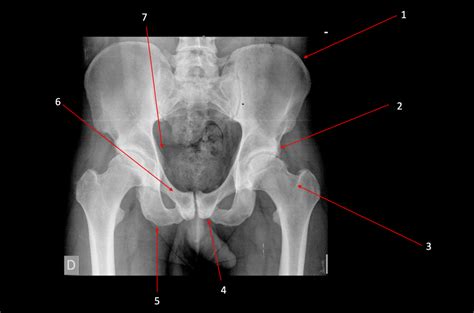 Diagram Of Ap Pelvis Xray 2 Quizlet