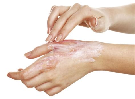 Мелем за изгореници